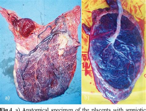Amniotic Sheet Semantic Scholar