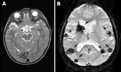 Cerebral Cavernous Malformation New Molecular And Clinical Insights