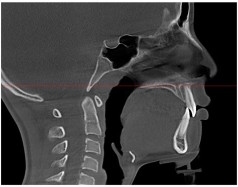 Factors Associated With The Proximity Of The Incisive Canal To The