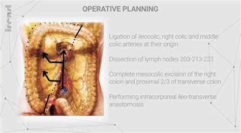 Denis Kravtsov On Linkedin Laparoscopic Extended Right Hemicolectomy With D3 Lymphadenectomy A…