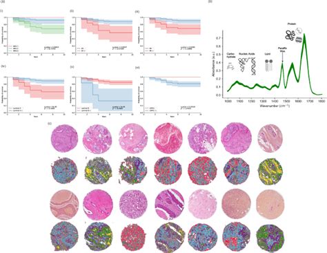 Prediction Of Post Treatment Recurrence In Early Stage Breast Cancer Using… Radiation And
