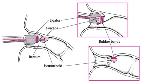 Image Banding A Hemorrhoid Msd Manual Consumer Version