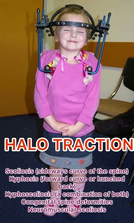 Halo Traction Everything You Need To Know Healthhints Youtube