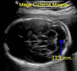 Cisterna Magna Ultrasound