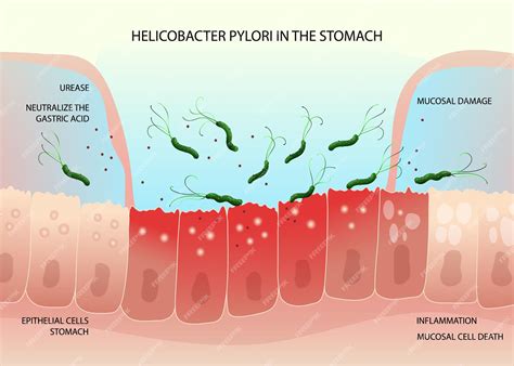 Premium Vector Helicobacter Pylori Bacteria On Inflamed Epithelial