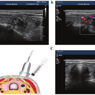 Thyroid Nodules Biopsy