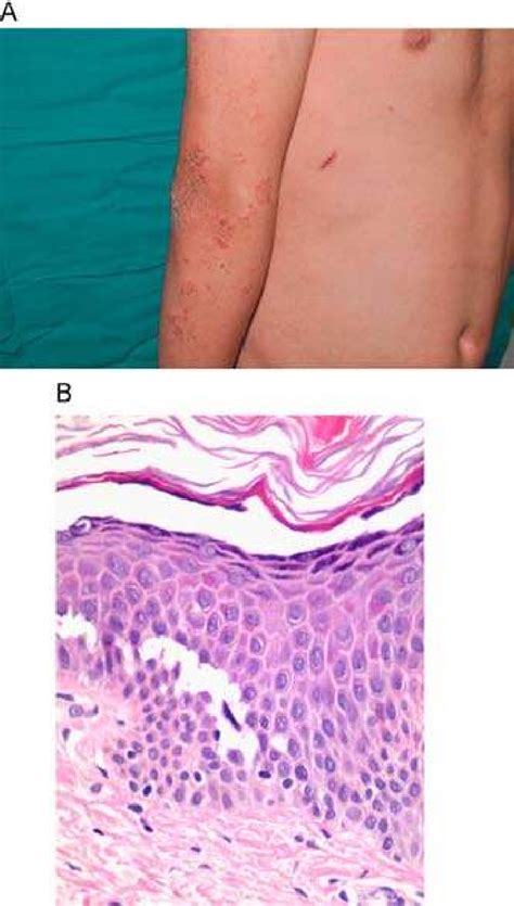 A Erosive And Crusted Lesions On The Arm Of A Patient With Ectodermal