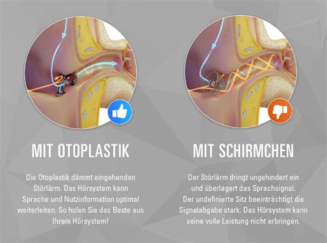 Titan Otoplastiken Ein Elementarer Baustein Für Eine Erfolgreiche