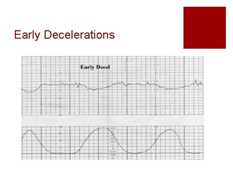 Electronic Fetal Heart Rate Monitoring Aka Reading Strips