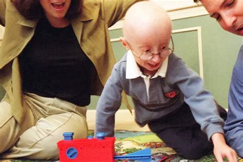 What Is Progeria Causes Symptoms And Treatment