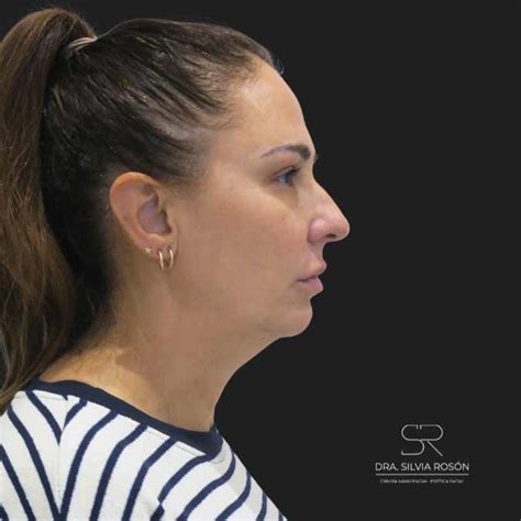 Lifting Cervical En Madrid [precio Lifting De Cuello] Dra Rosón