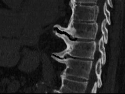 Scary Osteophytes Rradiology