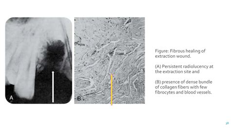 Healing Of Extraction Socket Power Point Presentation Pptx