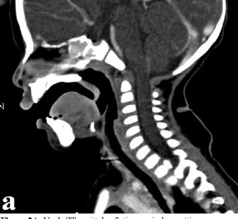 [pdf] Bacterial Tracheitis A Case Report Semantic Scholar
