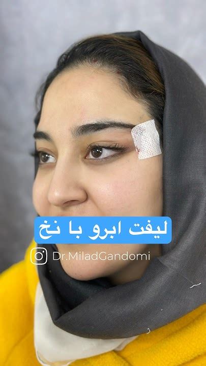 لیفت ابرو با نخ در افراادی که دچار افتادگی ابرو هستند باعث زیباتر شدن چهره می شودنخ لیفتنخ