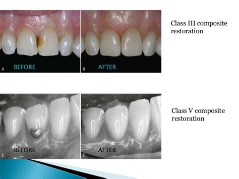 Composite Class 3 And Class 5
