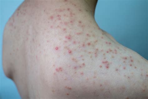 Prevent And Treat Folliculitis Naturally