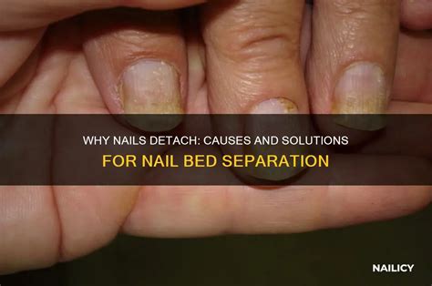 Why Nails Detach Causes And Solutions For Nail Bed Separation Nailicy