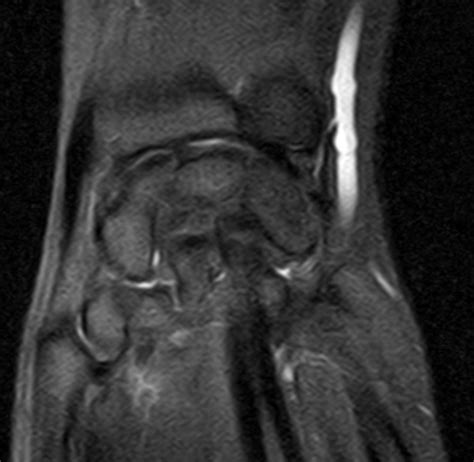 Triangular Fibrocartilage Complex Mri Sumers Radiology Blog