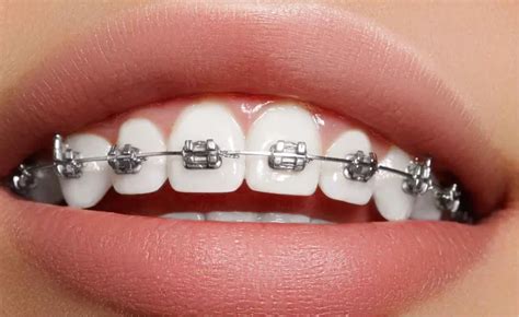 Gentle Braces