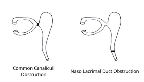 Lacrimal Syringing Procedure Result Indication And Contraindications Roplas Eye Health Nepal