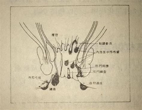 世界村与您分享：人为什么会长痔疮，怎样防治？ 知乎