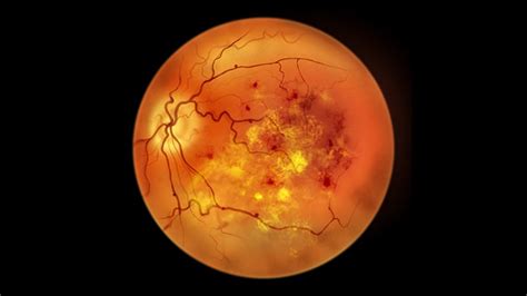 Rare Eye Disease Gets First Nhs Drug Recommendation News Directory 3