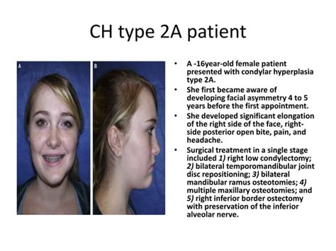 Condylar Hyperplasia Ch Pptx Bone And Joint Conditions Diseases