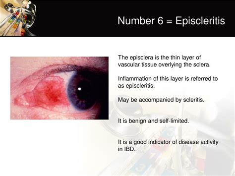 Ppt Ibd Picture Quiz Powerpoint Presentation Free Download Id2399869