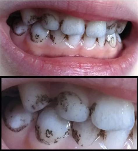 Dental 𝗖𝗵𝗿𝗼𝗺𝗼𝗴𝗲𝗻𝗶𝗰 𝗣𝗲𝗱𝗶𝗮𝘁𝗿𝗶𝗰 𝗦𝘁𝗮𝗶𝗻𝗶𝗻𝗴 𝗢𝗳 𝗧𝗲𝗲𝘁𝗵 🟦 It Is A Form Of