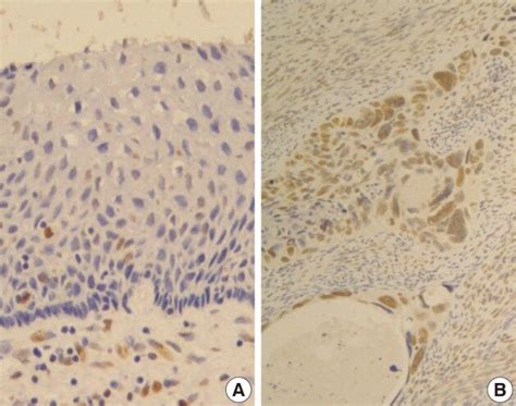Snail 1 Immunoexpression In Normal A And Neoplastic B Squamous