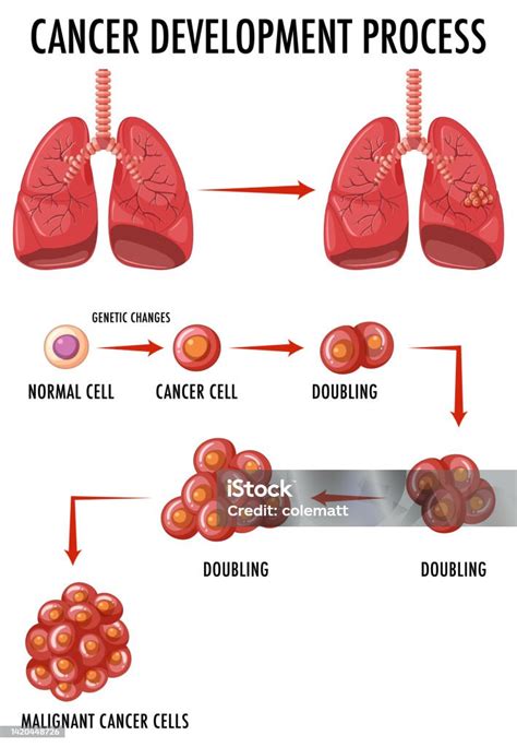 Diagram Menunjukkan Sel Normal Dan Kanker Pada Manusia Ilustrasi Stok Unduh Gambar Sekarang