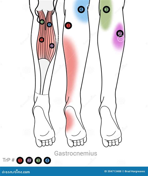 Gastocnemius Calf Muscle Myofascial Trigger Points Royalty Free Cartoon