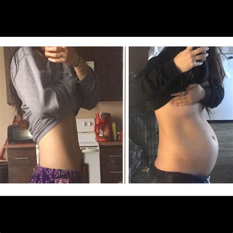 Ruptured Ovarian Cyst Bleeding