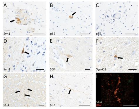 Photomicrographs Of Kd Cases Demonstrating α Synuclein Immunoreactive