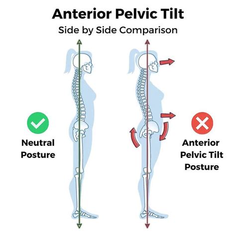 Correction Of Pelvic Tilt