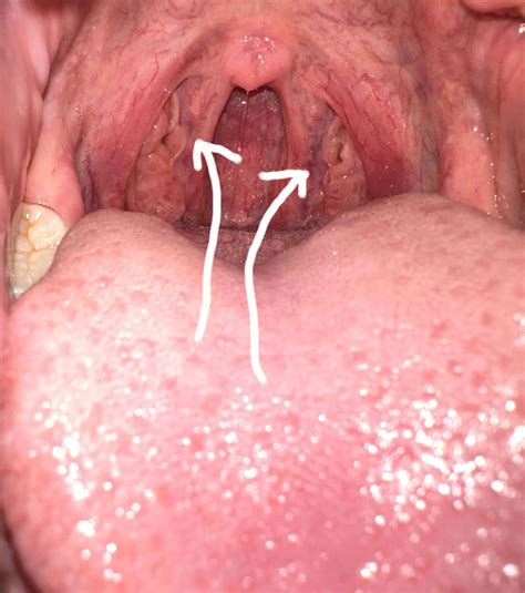 Tonsil Stones Holes And Crypts In The Tonsils Bad Breath Halitosis