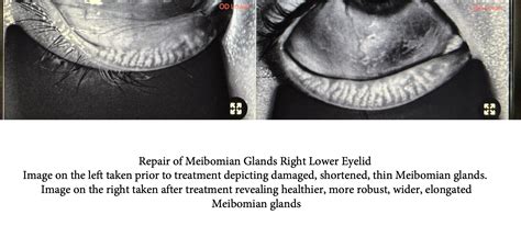 Treating Mgd The Dry Eye Treatment Center