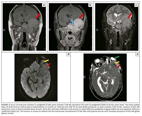 Multiple Myeloma In A Young Female Presenting As An Aggressive Skull