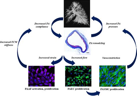 Vascular Remodeling In Pulmonary Arterial Hypertension Is Manifested By