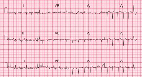 Ecg Case 147 Digoxin Effect With Possible Digoxin Toxicity Manual Of Medicine