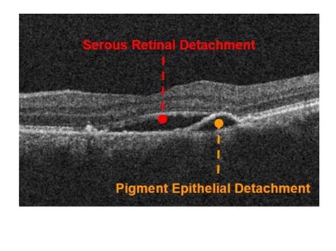 Pigment Epithelial Detachment Ped Pptx Eye And Vision Conditions