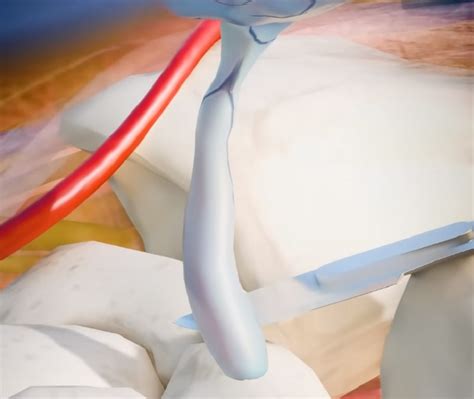 Can A Vitamin Deficiency Contribute To The Formation Of A Ganglion Cyst