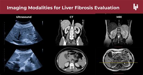 Navigating Liver Fibrosis Innovations In Imaging And Detection