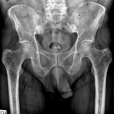 Generalized Osteopenia Radiology Reference Article Radiopaedia Org