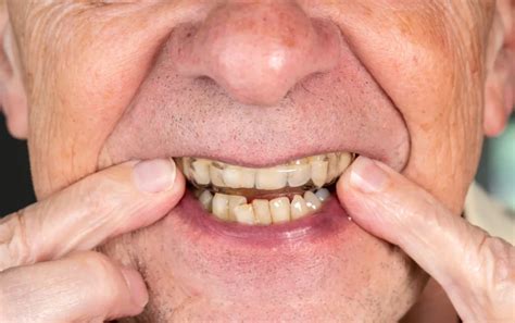Stained Teeth Causes Prevention And Professional Treatment Options