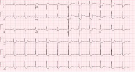 Truelearn Anesthesia Flashcards Quizlet