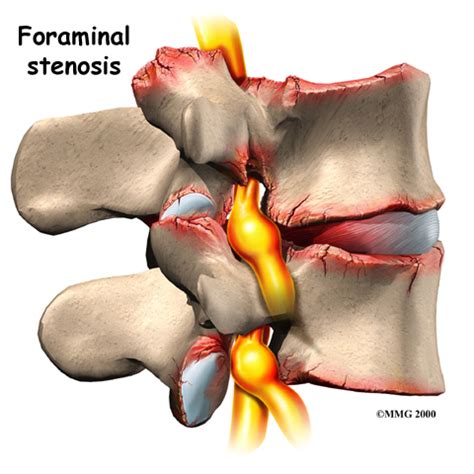 Lumbar Neural Foraminal Stenosis