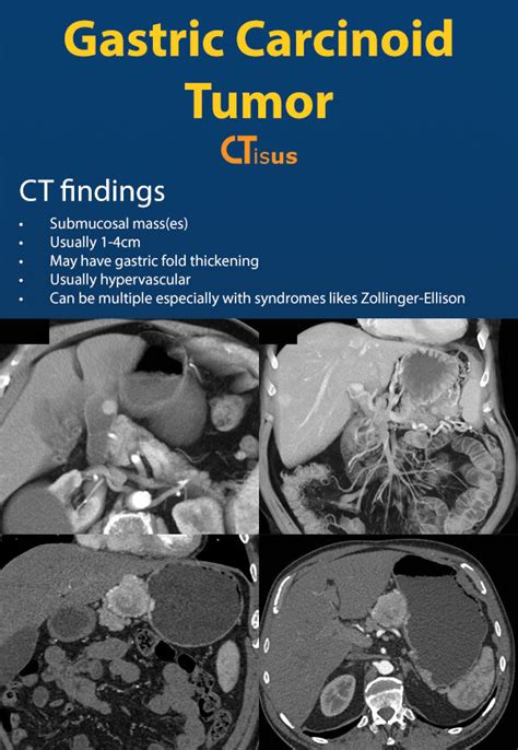 Gastric Carcinoid Tumor Euget7qx Ctisus