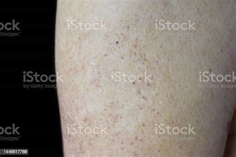 Age Spots And White Patches On The Arm They Are Brown Gray Or Black